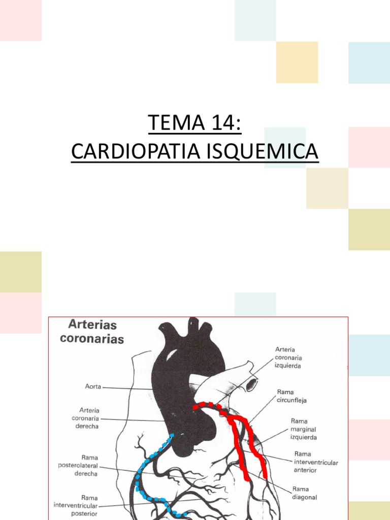Etiología y diagnóstico de cardiopatía isquémica | PDF | Infarto de ...