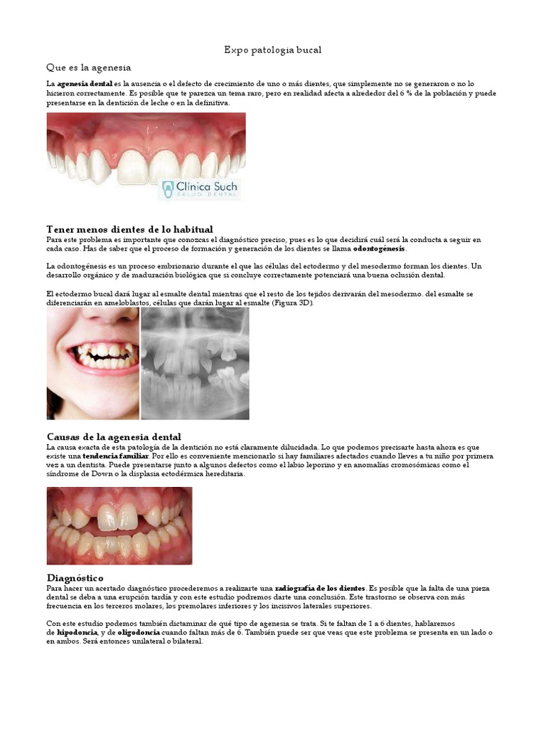 Agenesia Dental: Causas y Tratamientos | PDF | Diente | Ortodoncia