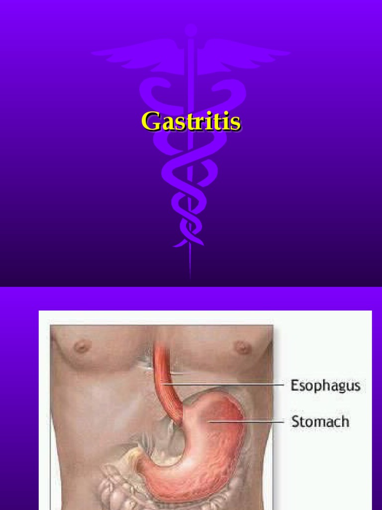 Gastritis PPT | PDF