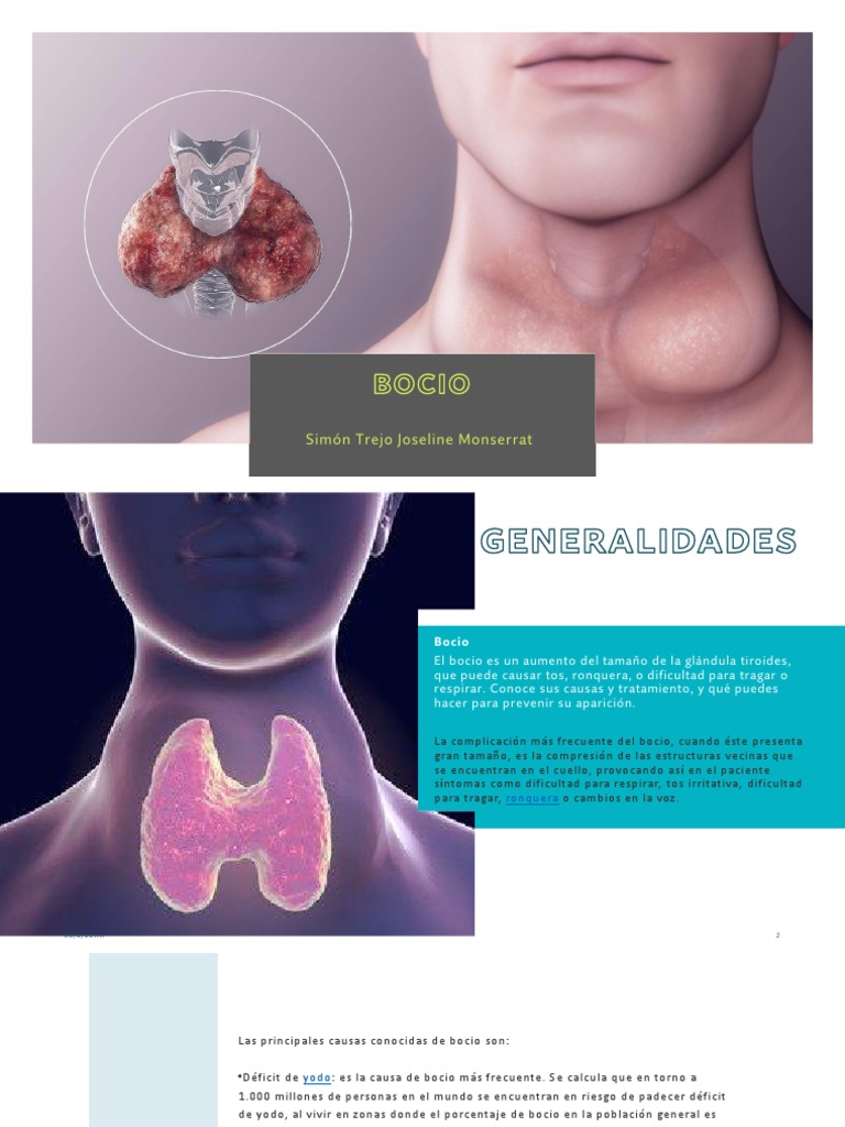 Causas y tratamiento del bocio | PDF | Tiroides | Yodo