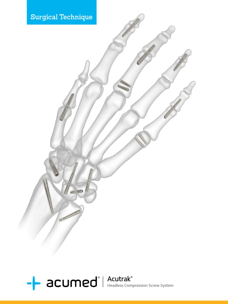 Acumed Surgical Technique EN Acutrak Headless Compression Screw System ...
