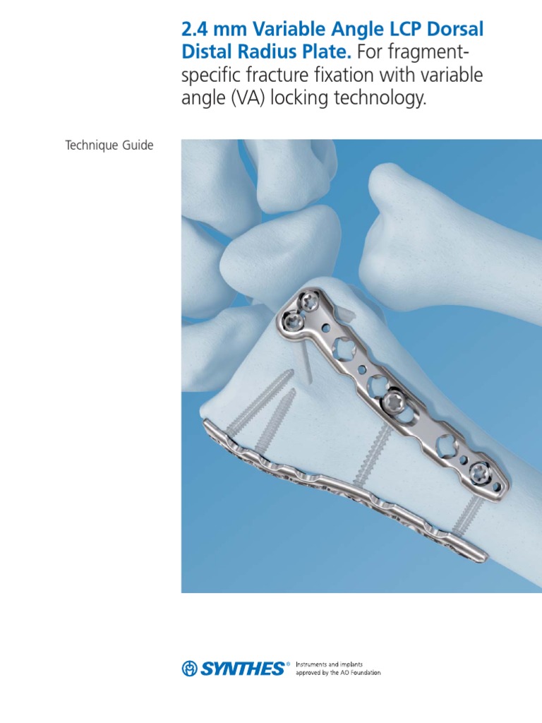 Dorsal Distal Radius Variable Angle | Download Free PDF | Screw ...