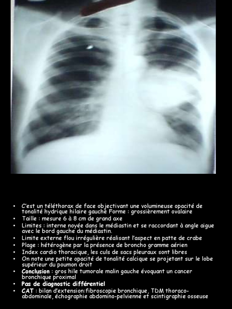 Téléthorax : Analyse des Opacités Pulmonaires | PDF