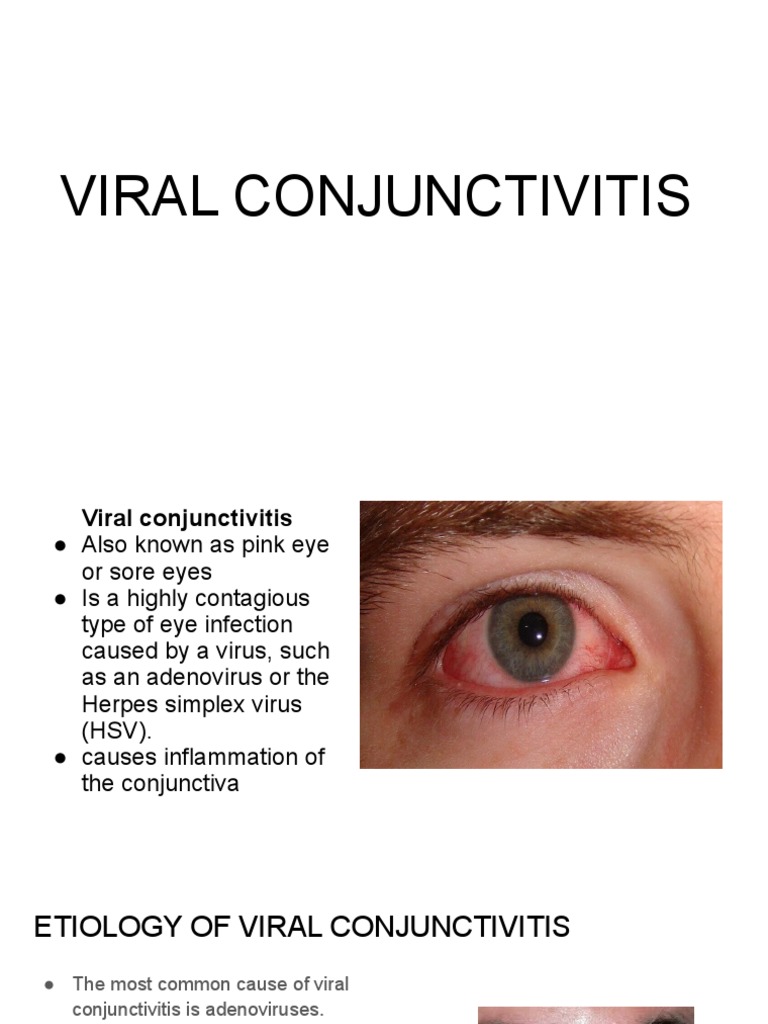 Viral Conjunctivitis | PDF | Infection | Adenoviridae