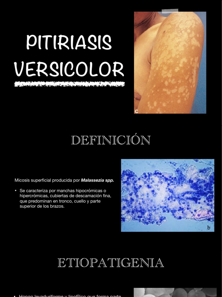 PITIRIASIS VERSICOLOR | PDF