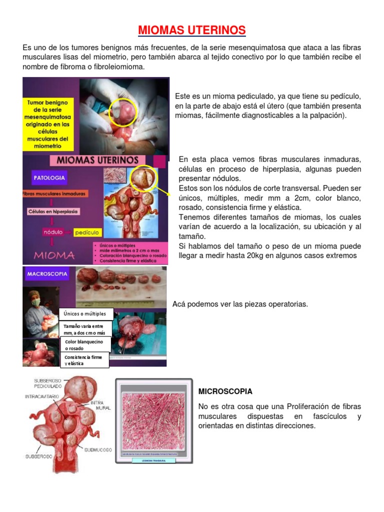 Miomas Uterinos | PDF | Músculo esquelético | El embarazo