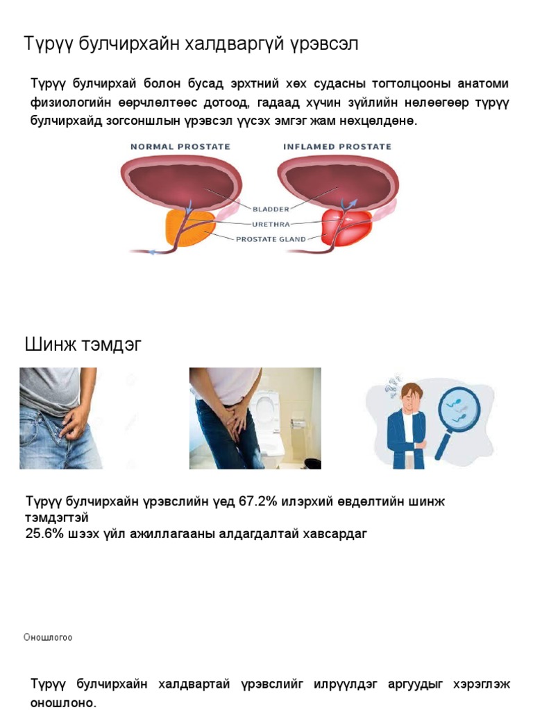 Түрүү булчирхайн үрэвсэл Pdf
