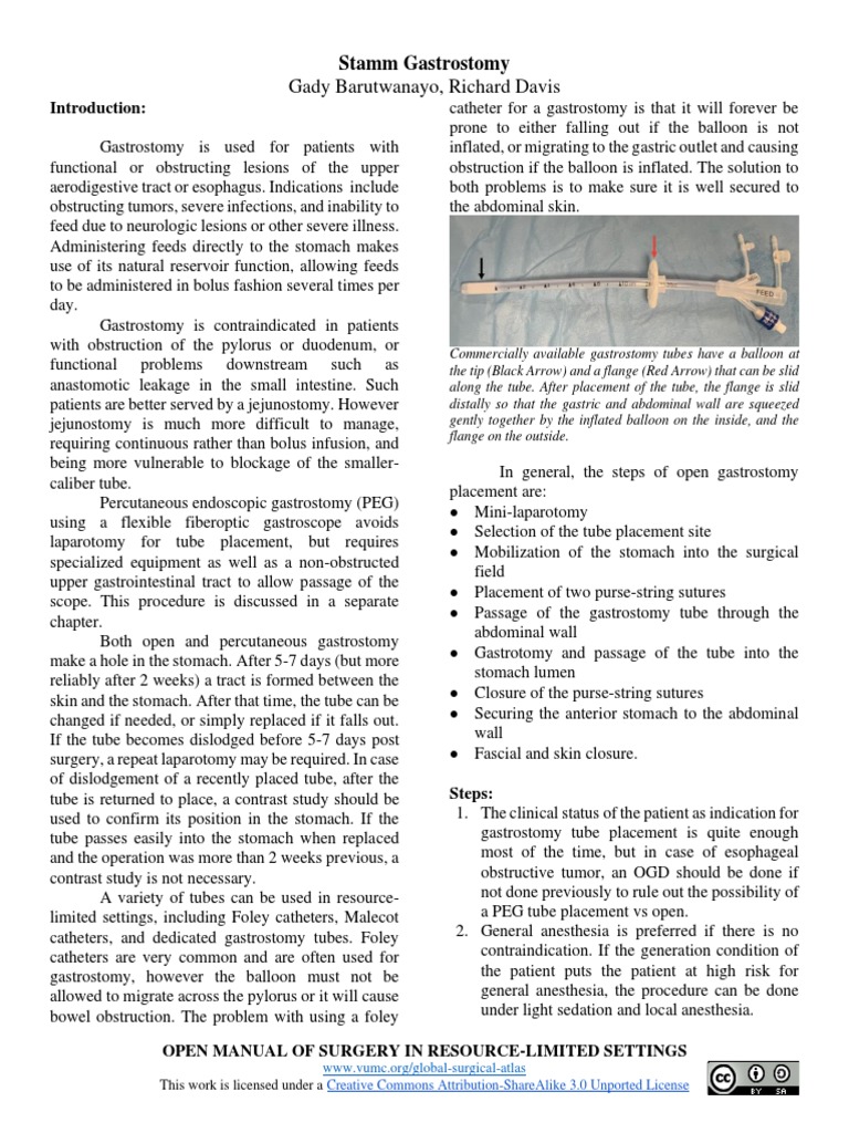 Stamm Gastrostomy Procedure Steps | PDF | Surgical Suture | Medicine