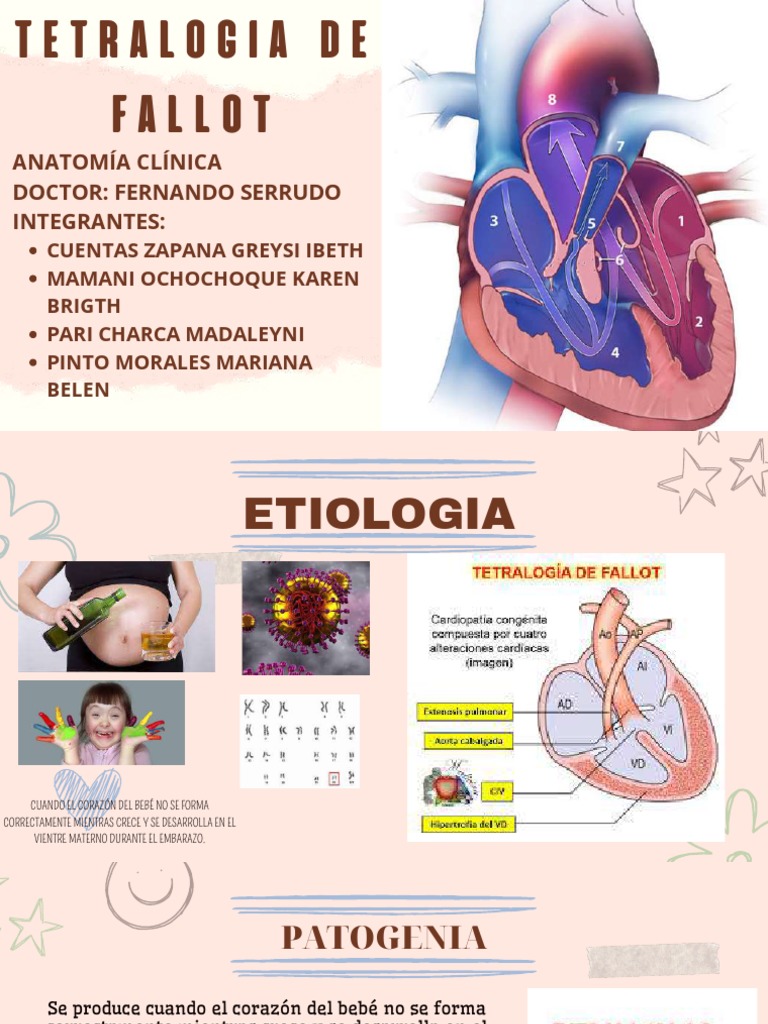Tetralogia de Fallot (1) - Compressed | PDF | Cardiología | Medicina
