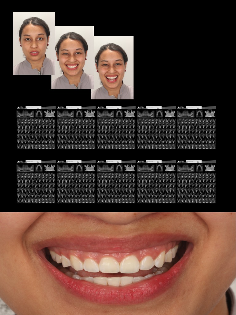 Crown Leng. 11 - 9,5mm | PDF