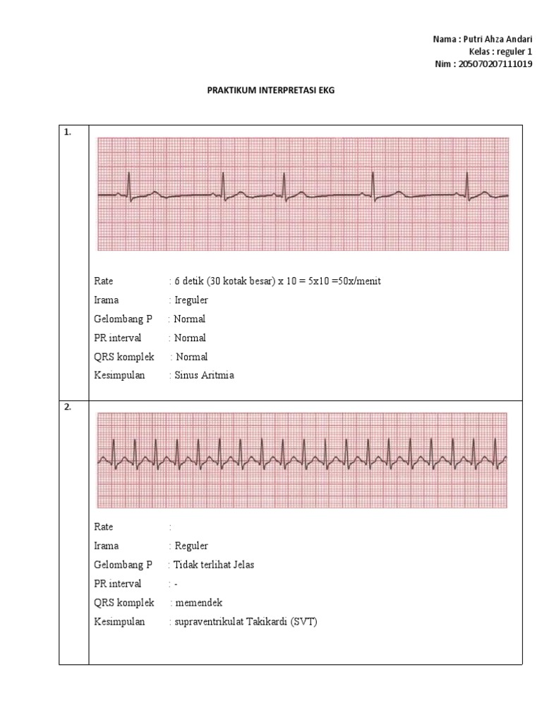 Tugas Interpretasi EKG | PDF