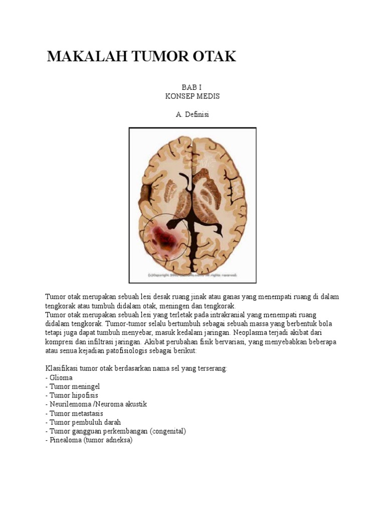 Makalah Tumor Otak | PDF