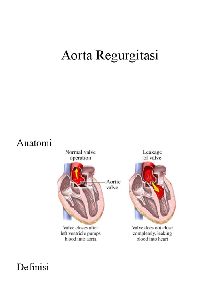 Regurgitasi Aorta | PDF