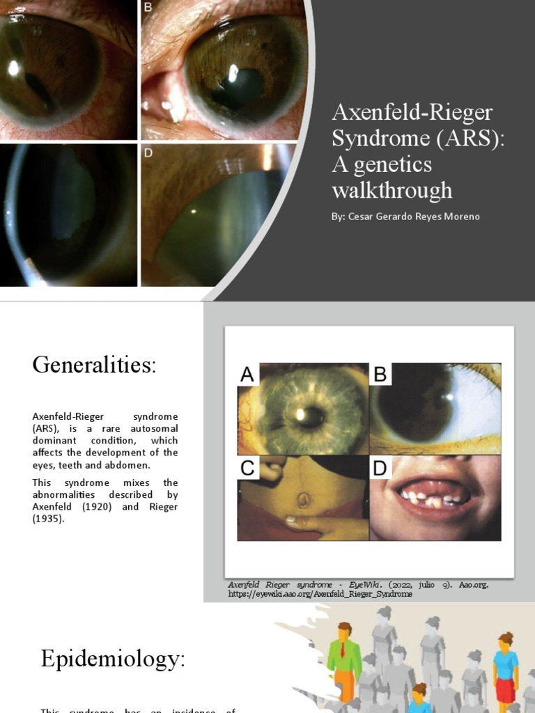 Axenfeld-Rieger Syndrome (ARS) | PDF | Diseases And Disorders ...