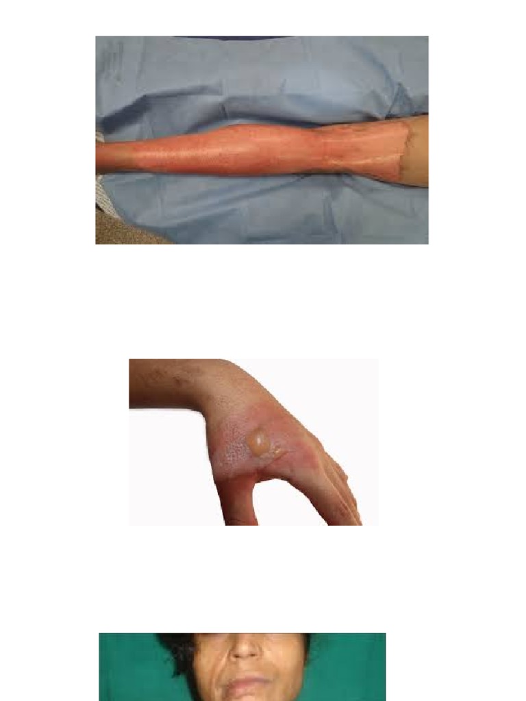 BURNS | PDF | Burn | Wound