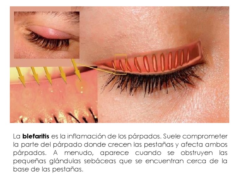 La blefaritis: causas y síntomas de la inflamación de los párpados | PDF