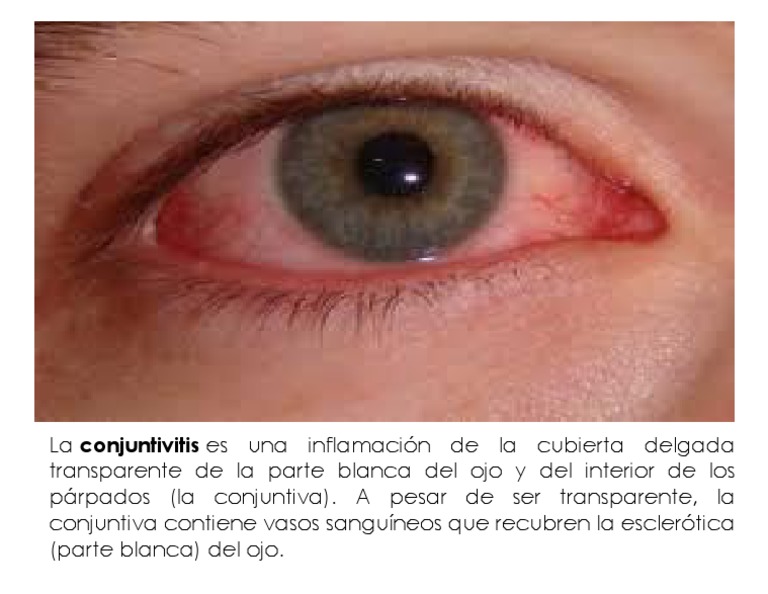 Conjuntivitis | PDF