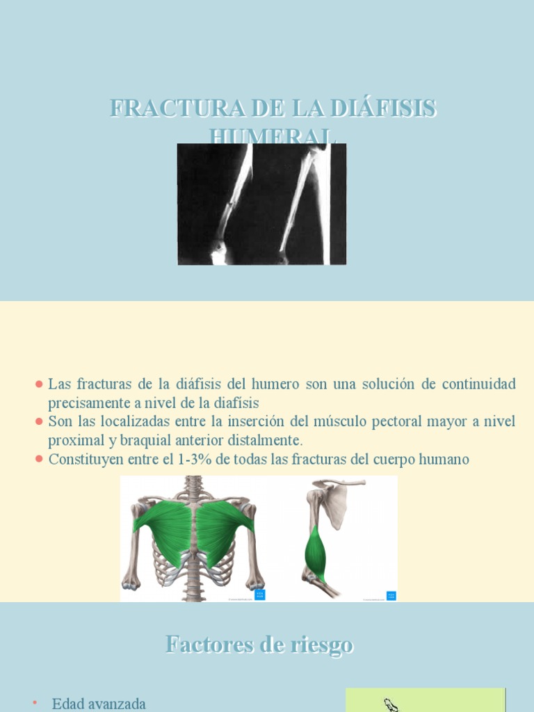 FRACTURA DE LA DIÁFISIS HUMERAL | PDF | Hueso | Lesión