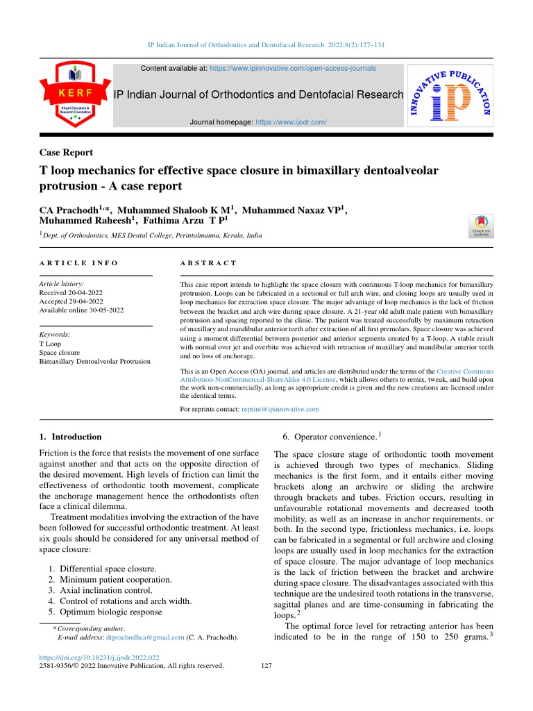 T Loop Mechanics For Effective Space Closure in Bimaxillary ...