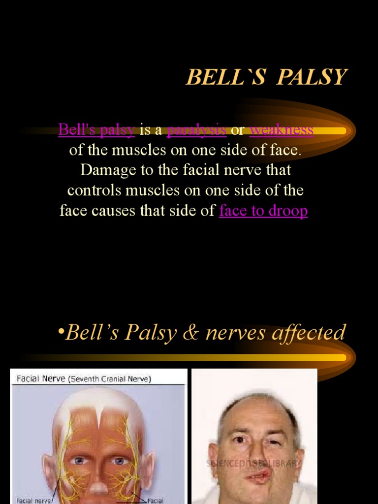 Understanding Bell's Palsy: Causes, Symptoms, Diagnosis and Treatment ...
