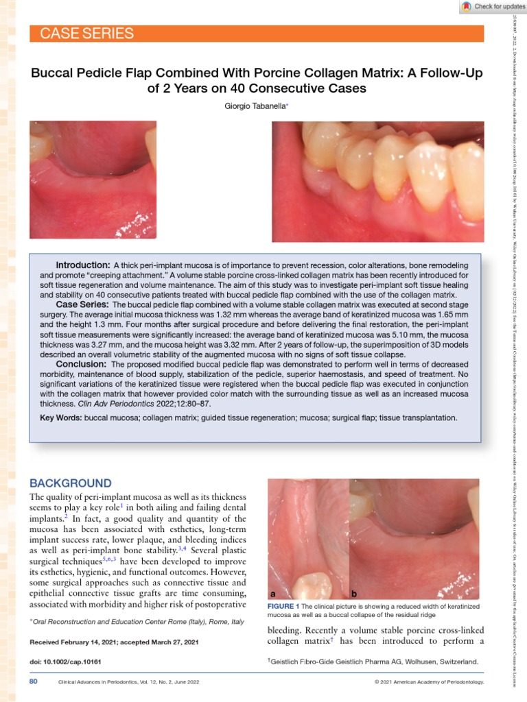 颊侧带蒂瓣 Clin Adv Periodontics - 2021 - Tabanella - Buccal Pedicle Flap ...