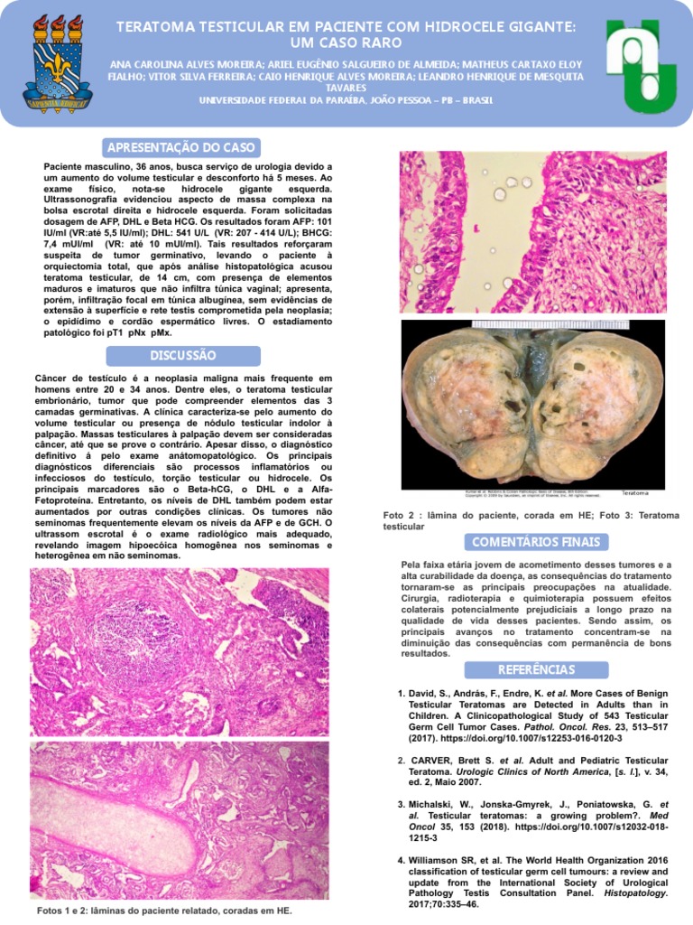 27 - Teratoma Testicular em Paciente Com Hidrocele Gigante Um Caso Raro ...