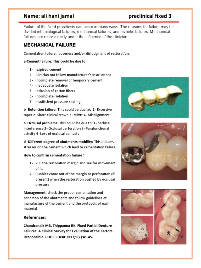 Failure of The Fixed Prosthesis Can Occur in Many Ways | PDF
