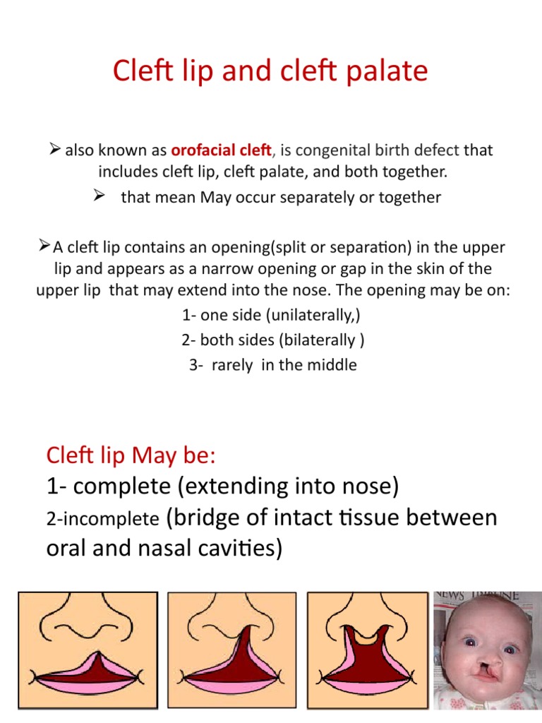 Cleft Lip and Cleft Palate | PDF | Human Nose | Health Sciences