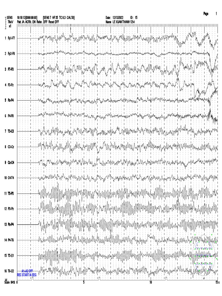 Eeg Review | PDF