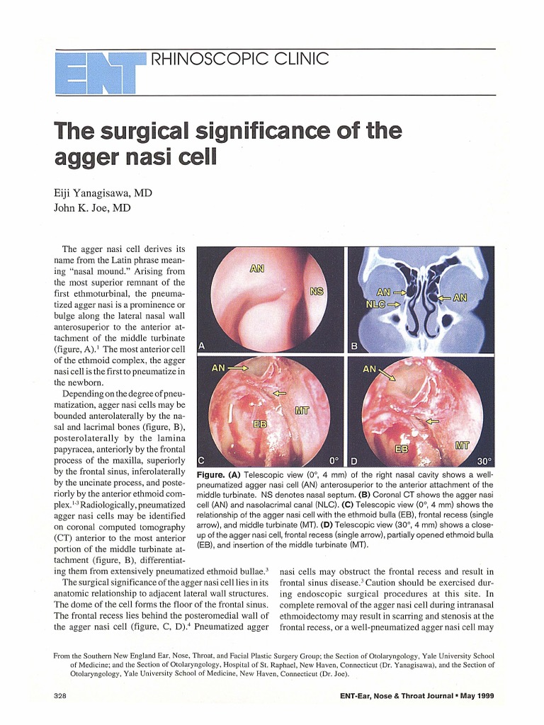 The Surgical Significance of the Agger Nasi Cell: An Anatomical ...