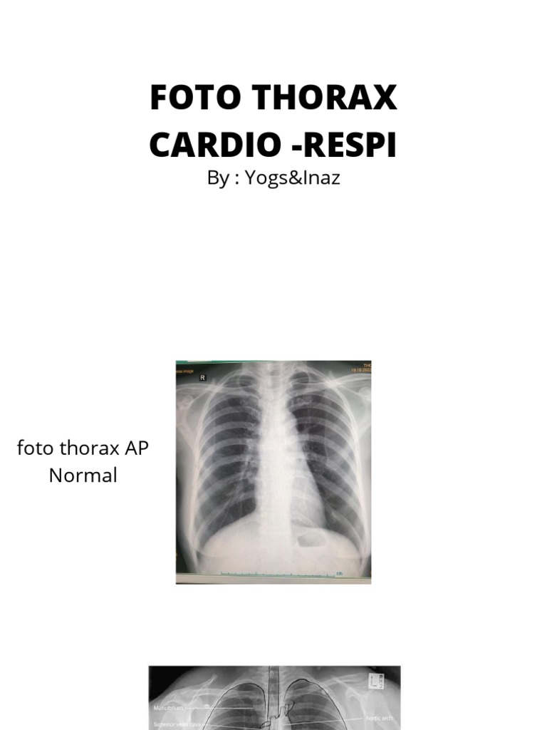 Foto Thorax AP Normal | PDF