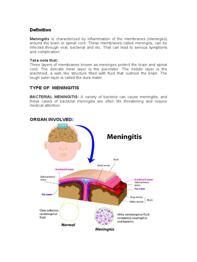Case Study Bacterial Meningitis | PDF | Meningitis | Immunology