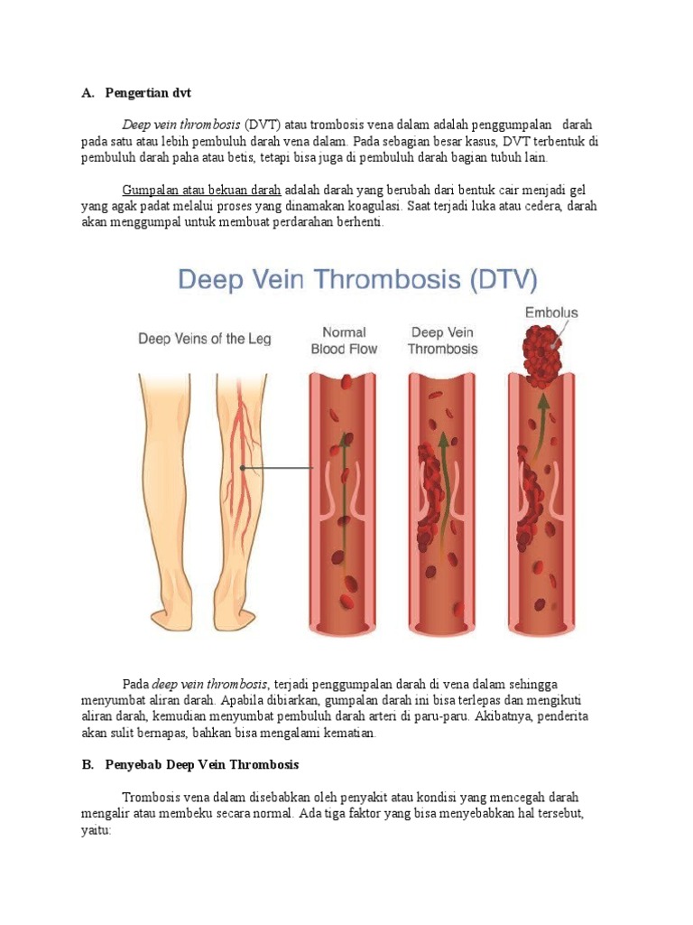 LP DVT | PDF