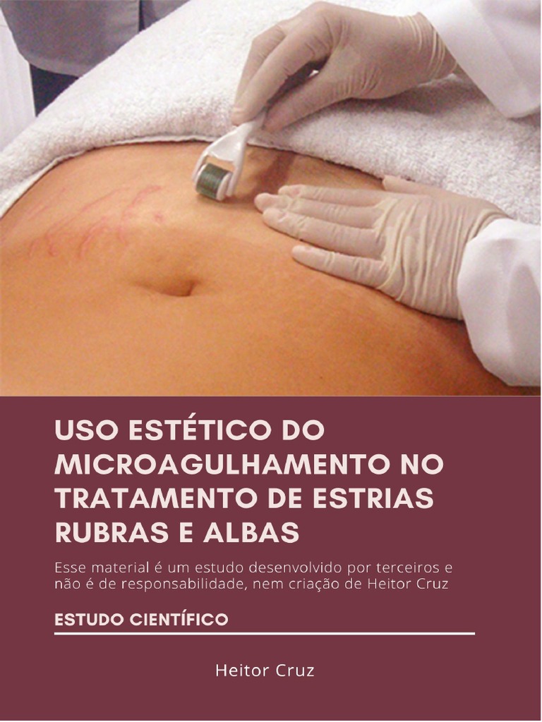 Uso Estetico Do Microagulhamento No Tratamento de Estrias Rubras e Alpas Mayara Guimaraes Da ...