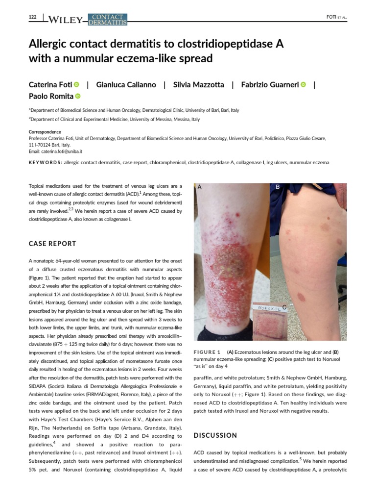 Allergic Contact Dermatitis To Clostridiopeptidase A With A Nummular ...