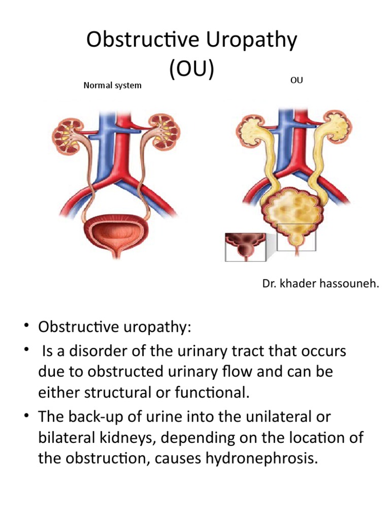 Understanding Obstructive Uropathy | PDF | Medical Specialties ...