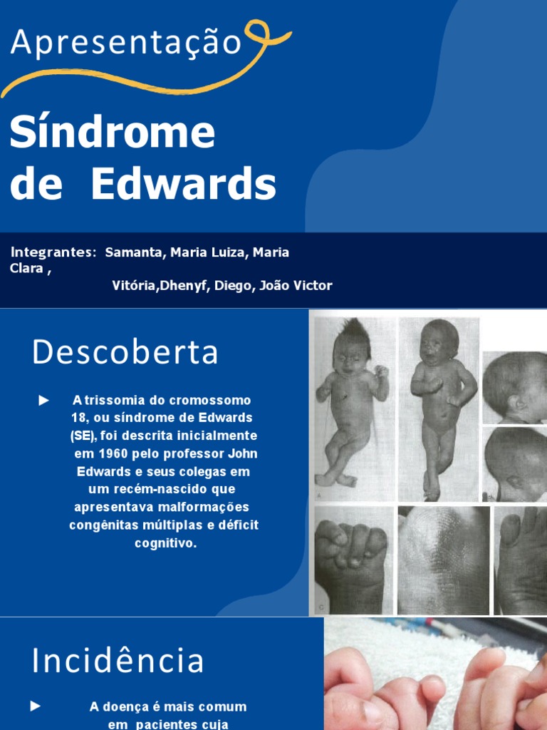 Sindrome Edwards Apresentação | PDF
