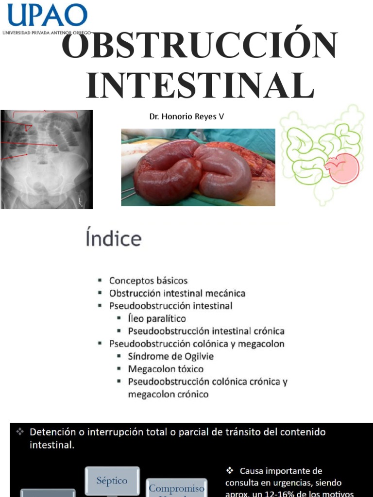 Obstrucción Intestinal | PDF