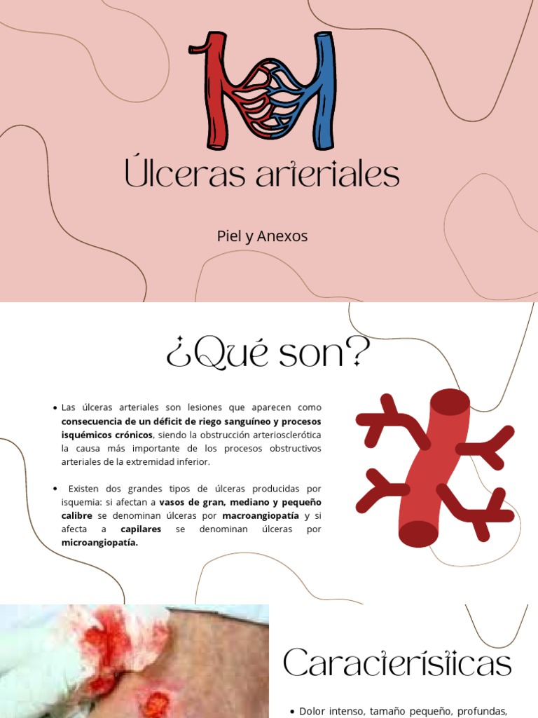 Clasificación y tratamiento de úlceras arteriales | PDF | Isquemia ...