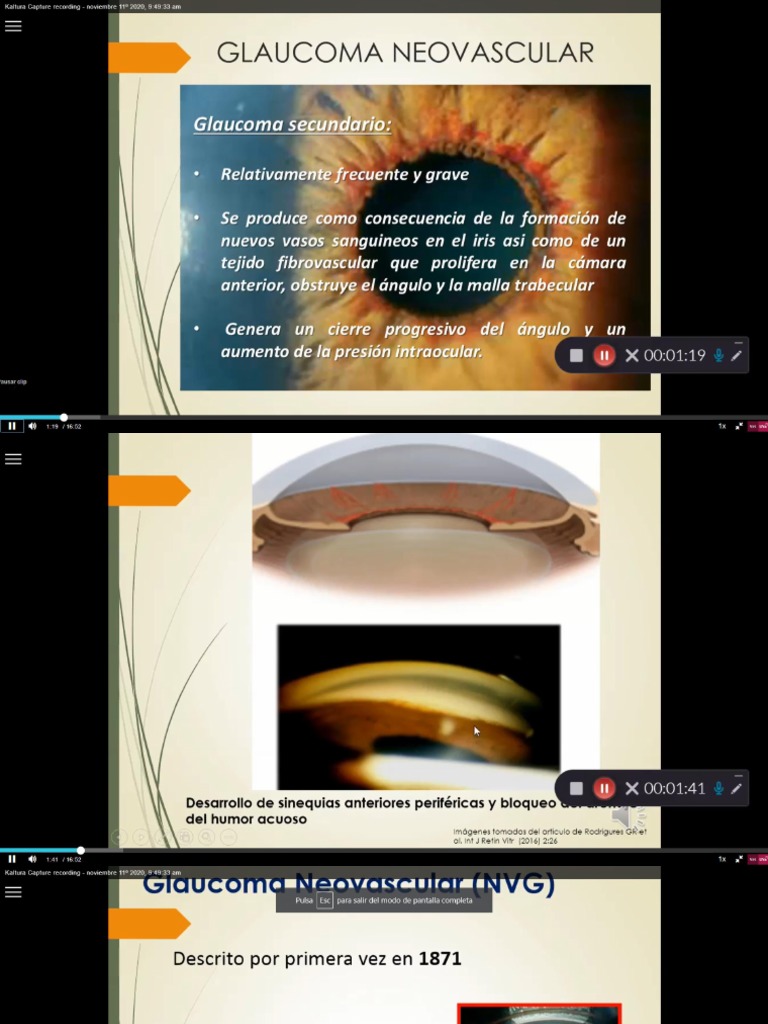 Glaucoma Neovascular | PDF
