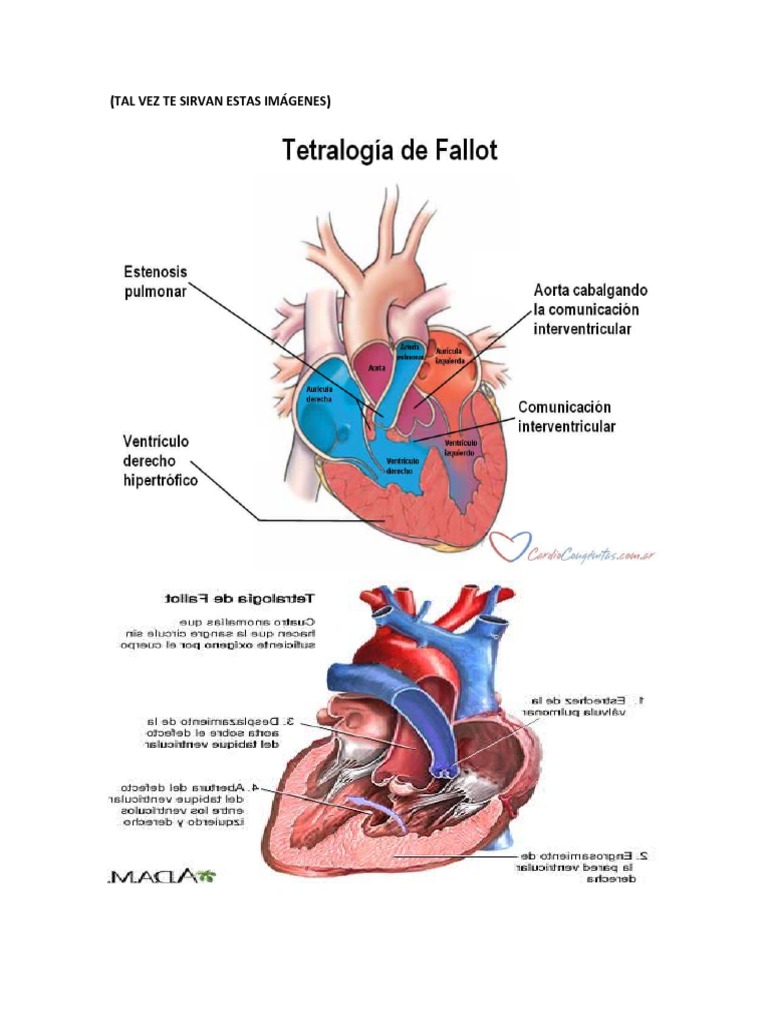 Tetralogia de Fallot | PDF