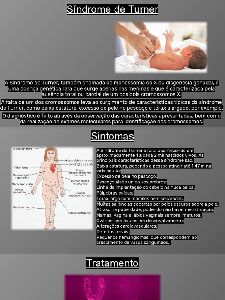 Síndrome de Turner | PDF