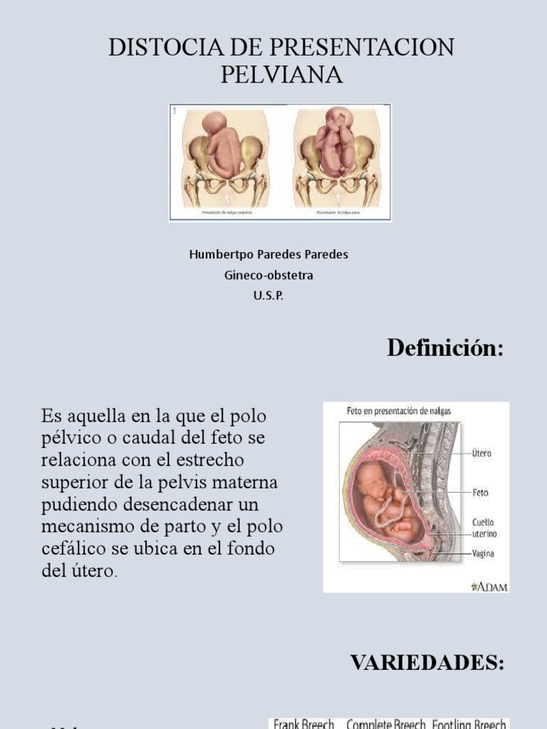 Distocia de Presentacion Pelviana | PDF | Parto | El embarazo