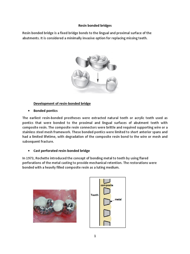Resin Bonded Bridges | PDF | Materials | Dentistry Branches