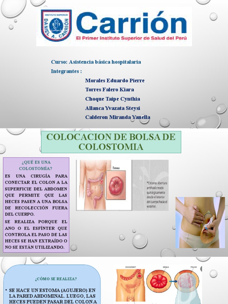 COLOCACION DE BOLSA DE COLOSTOMIA Y SONDA RECTAL - Carrion | PDF | Cáncer colonrectal | Sistema ...
