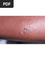 Disseminated Gonococcal Infection Skin Lesions High | PDF