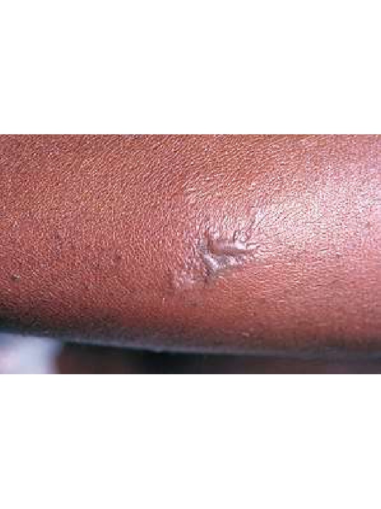 300px-Gonococcal Lesion On The Skin PHIL 2038 Lores | PDF