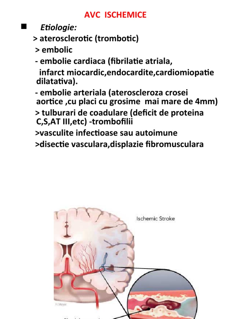 AVC Ischemic | PDF