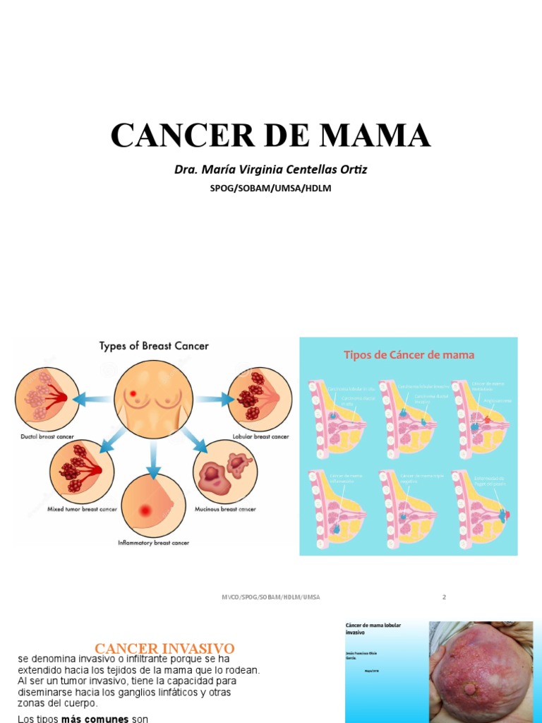 Cancer de Mama | PDF | Cáncer de mama | Cáncer