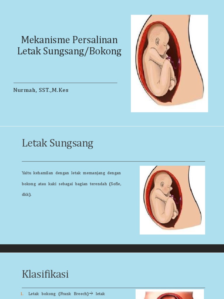 Mekanisme Persalinan Presentasi Bokong (Term 2) Ok | PDF